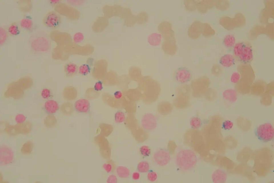 看精准诊断下AML伴TP53突变该如何诊断_腾讯新闻