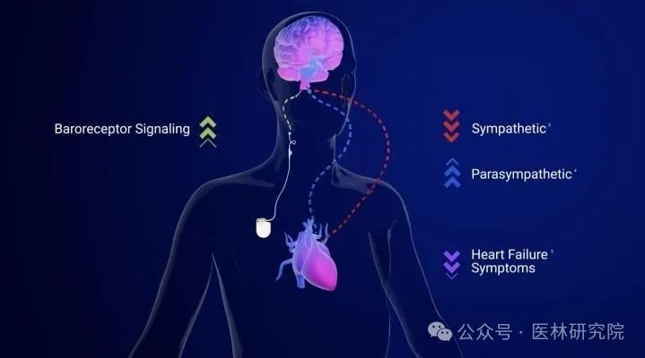 Barostim：颈动脉窦刺激疗法对HFrEF心力衰竭长期效果显著_腾讯新闻