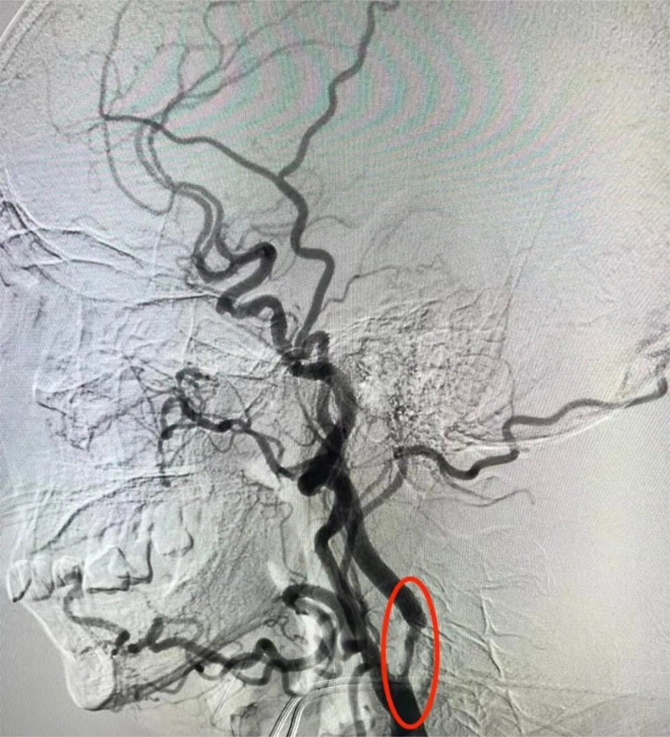 急！7旬老人突发脑梗死，颈动脉支架置入术撑起狭窄“一线天”_腾讯新闻