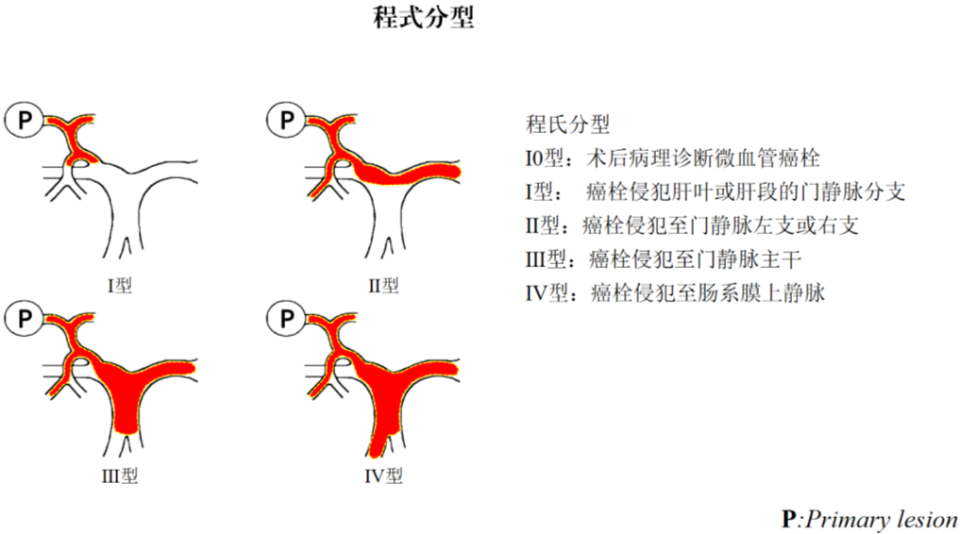 一文全览！肝癌合并 PVTT 的分型及治疗策略_腾讯新闻