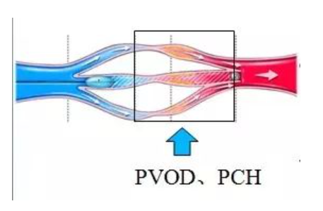 郭璐教授：肺静脉闭塞病（PVOD）和肺毛细血管瘤病（PCH），藏在「肺动脉高压」背后的凶险疾病，如何有效进行鉴别诊断？_腾讯新闻