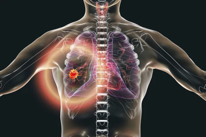 肺癌前沿丨I/II期CodeBreaK 100研究2年汇总分析：迄今最长的KRAS G12C抑制剂随访数据_腾讯新闻