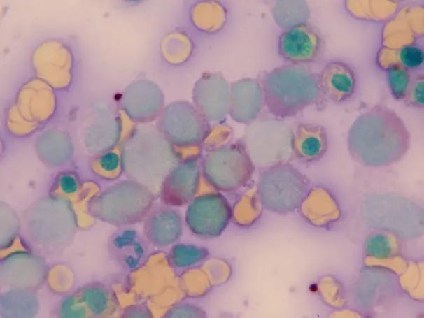 WHO和ICC“血战”，江湖谁有理？——一个案例精准梳理是AML-MR？还是AML-TP53突变？_腾讯新闻