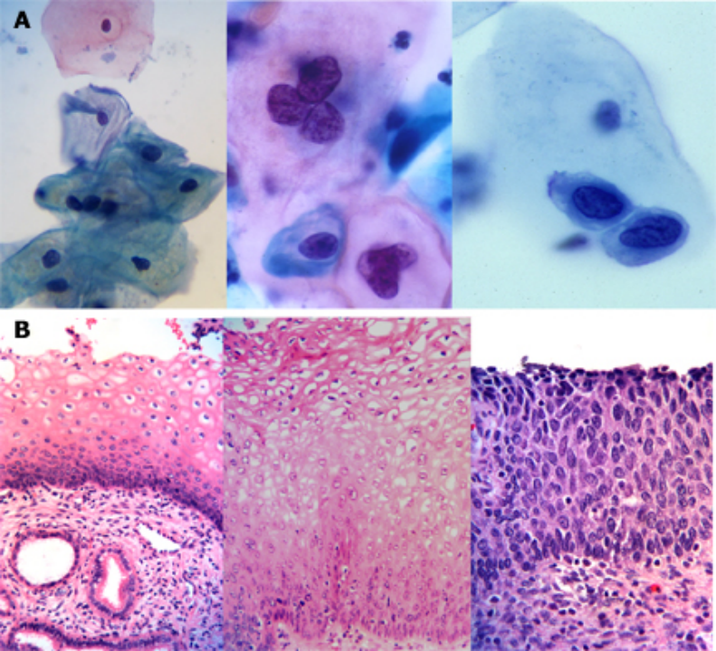 超全！「HPV、TCT、阴道镜」报告解读 + 后续处理一文总结！_腾讯新闻