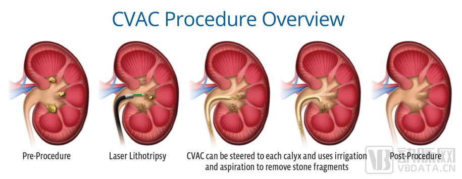 3.5亿融资！Calyxo的CVAC系统让结石清除率达96.1%_腾讯新闻