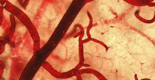 发作率降低96%！Ionis反义疗法Donidalorsen预防遗传性血管性水肿(HAE)的研究取得积极进展_腾讯新闻