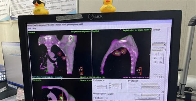 云南省肿瘤医院开展4D-CBCT图像引导联合Body-Fix体位固定等多项放疗新技术_腾讯新闻