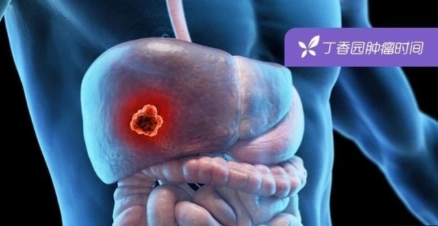 肝癌介入治疗：指南首推 TACE，而临床常用 HAIC，为什么？怎么选？_腾讯新闻