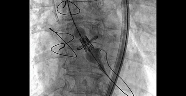 Wattson：首款专用于TAVR术中起搏的导丝获批FDA_腾讯新闻