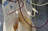 网约车司机腹痛进ICU抽出3000毫升“牛奶血”：饮食不规律且油腻，诱发急性胰腺炎_腾讯新闻