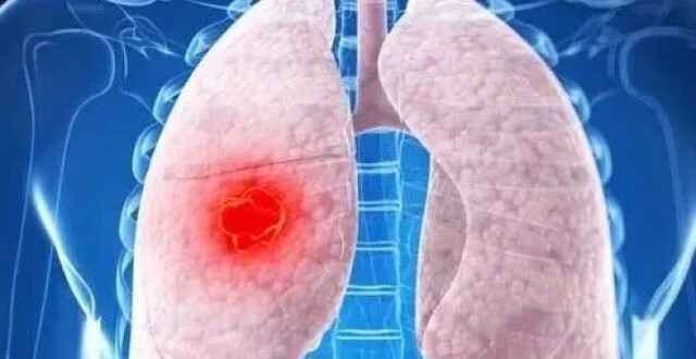 联合靶向！兰州大学第二医院(第二临床医学院)：克服肺腺癌免疫逃逸有前景的协同策略_腾讯新闻