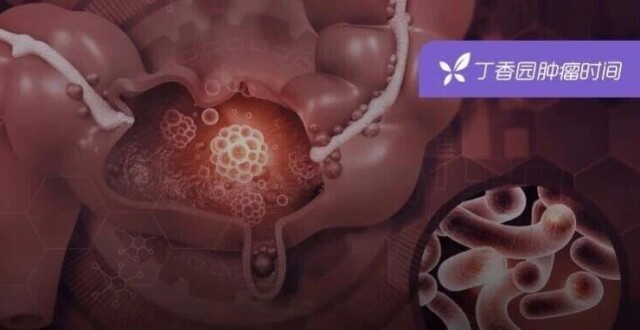 5 年 OS/DFS/EFS 率均 100%! 结直肠癌新辅助免疫再添中国数据_腾讯新闻