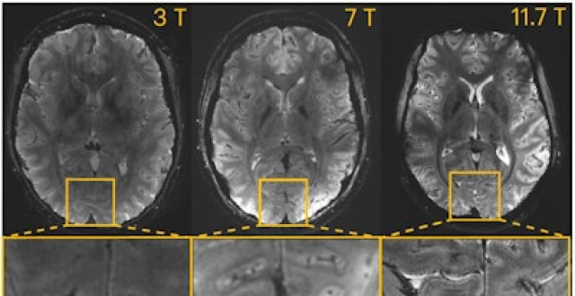 法国总统点赞：11.7T MRI新突破_腾讯新闻