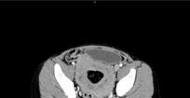 切勿掉以轻心！小孩贫血可能是肿瘤惹的祸_腾讯新闻