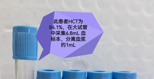 HCT＞0.55、HCT＞0.74患者凝血标本处理小技巧_腾讯新闻