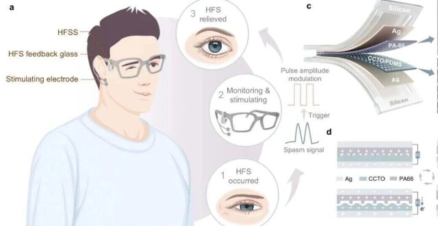 Nat Commun | 清华大学李翀团队实现基于非侵入式神经刺激的面肌痉挛监测及干预新途径_腾讯新闻