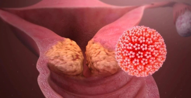 【Nature子刊】中山大学姚书忠团队：揭示宫颈癌治疗新的临床标志物_腾讯新闻