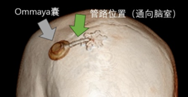 “国际”力量 | 精准治疗再添利器！北京大学国际医院神经外科Ommaya囊技术造福患者_腾讯新闻