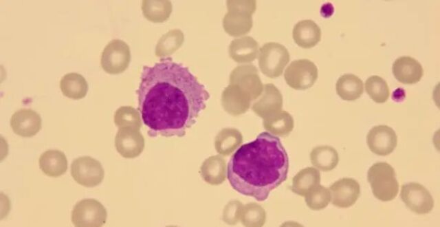 WHO和ICC“血战”，江湖谁有理？——一个案例精准梳理是AML-MR？还是AML-TP53突变？_腾讯新闻