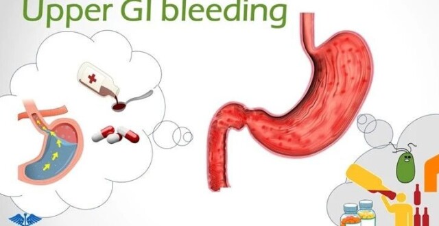 “止血奇兵”——内镜，如何应对上消化道出血_腾讯新闻